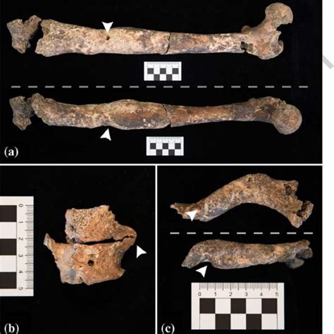 A Left Femur With Severe Osteomyelitis And Cloaca Upper Anterior