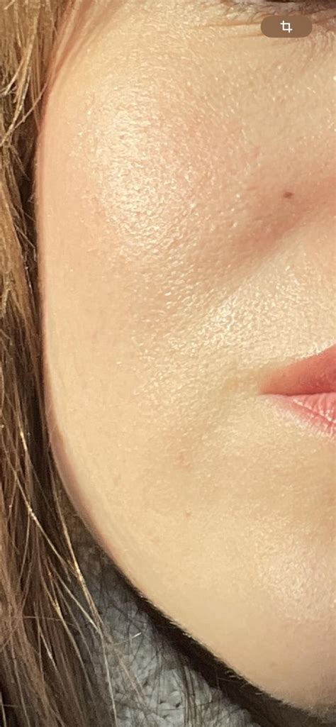 Could It Be Mild Rosacea Rrosacea