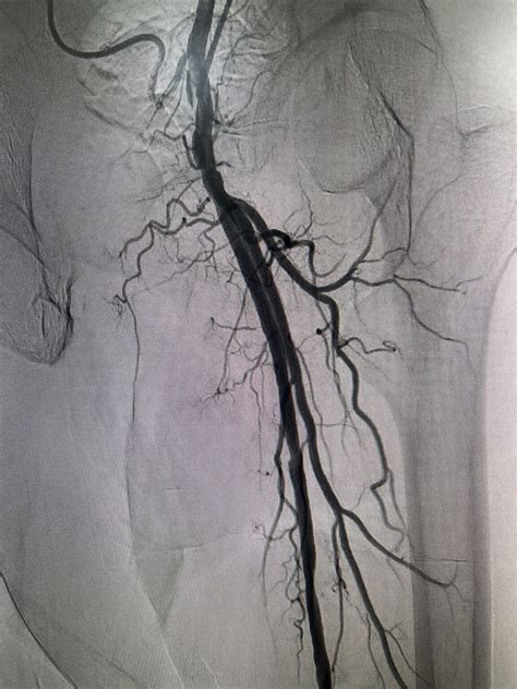 Endovascular Btk Cto Isvir Cirse Minimally Minimally Lijesh Kumar