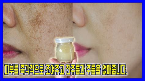 기미 검버섯 주근깨 한번에 쏙 떨어져 나간다 피부를 즉각적으로 조여주고 잔주름과 주름을 없애줍니다 Youtube