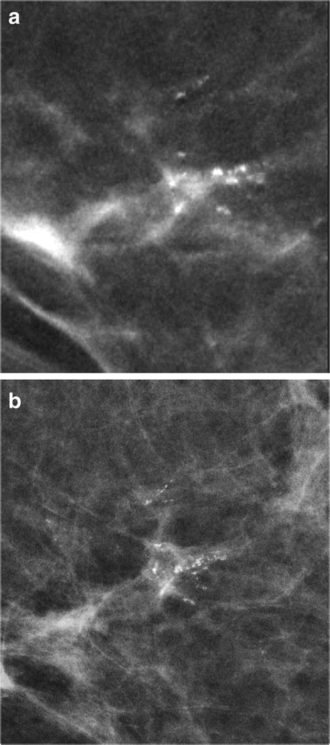 The Morphology Of Calcifications On Synthetic Mammograms Generated From Download Scientific