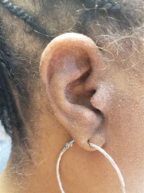 Flesh Colored Pinpoint Papules With Fine White Spicules On The Upper Body Mdedge Dermatology Flesh Colored Pinpoint Papules With Fine White Spicules On The Upper Body Mdedge Dermatology