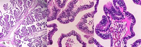 Papillary Choroid Plexus Neoplasm Showing Fibrovascular Cores A Lined
