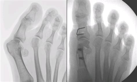 Scarf Osteotomie Operation Hallux Valgus Scarf Osteotomie Surgical Technique Gxixoj