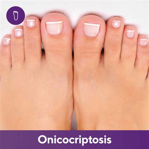Onicocriptosis Alta Capacitación Profesional