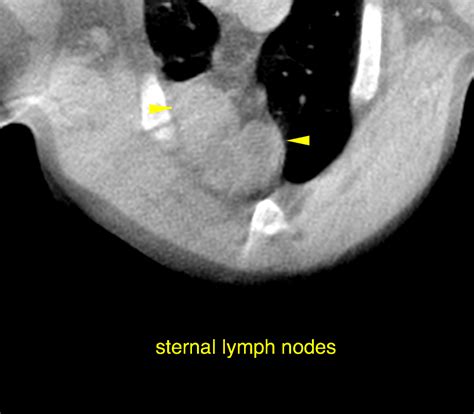 Ct Heart Base Tumor With Pericardial Effusion Likely Mediastinal