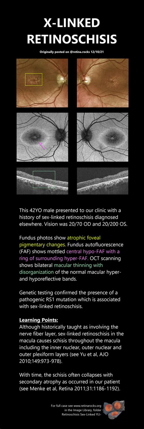 Inherited Retinal Diseases X Linked And Non X Linked Retinoschisis Retina Rocks