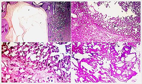 Sayed Attar On Linkedin Osteolytic Bone And Soft Tissue Mass At D6 Of 61 Y O Male Epithelioid…