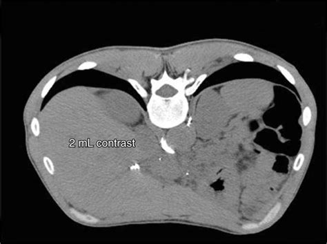 Celiac Plexus Block Using CT Guidance Anesthesia Key