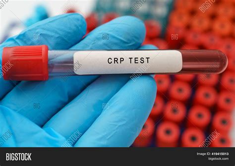 C Reactive Protein Image Photo Free Trial Bigstock