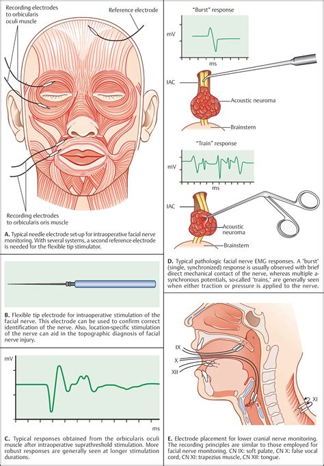 Surgical Therapy Of The Temporal Bone Neupsy Key