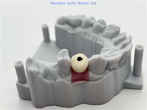 China Screw Retained Cobalt Chromium Porcelain Dental Implant Crown