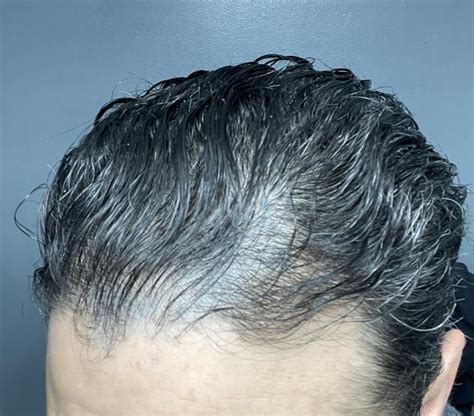Diffuse Thinner Needs Recs For Surgeons R Hairtransplants