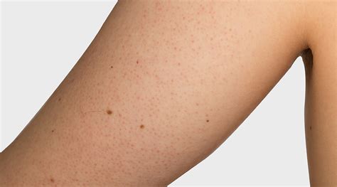 Your Bumpy Skin Might Be Keratosis Pilaris Rough And Bumpy Cerave