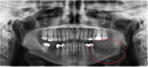 Jaw Bone Infection X Ray At Beth Heard Blog
