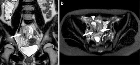 Mr Images In A 16 Year Old Girl With Appendicitis A B Coronal T2 W