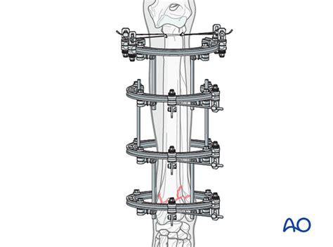 External Skeletal Fixation For Multifragmentary Extraarticular Fracture Of The Distal Radius