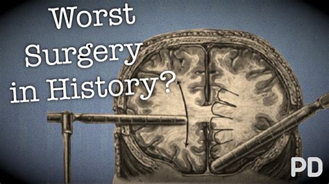 Lobotomy Procedure