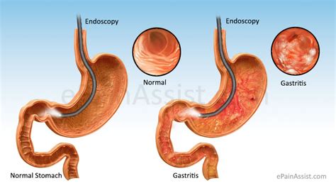 Gastritis Treatment Symptoms Causes Risk Factors