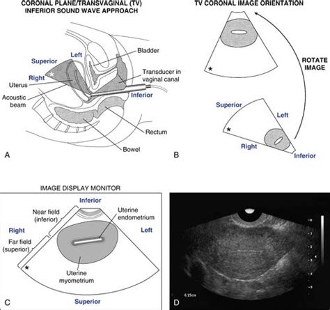 transvaginal scanning protocol for the female pelvis hot sex picture