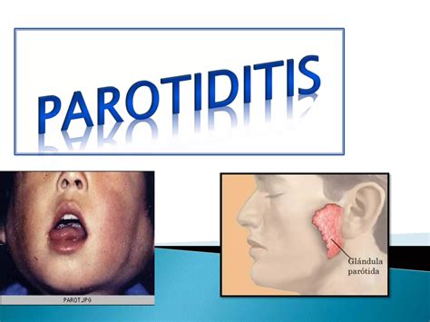 Parotiditis Taller De Salud Y Ambiente Pptx Infectious Diseases