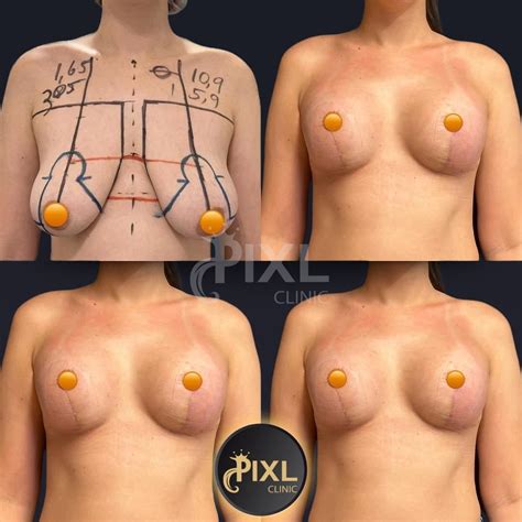 Breast Reduction Before And After Pixl Clinic