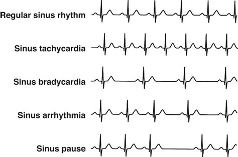 Sinus Arrhythmia