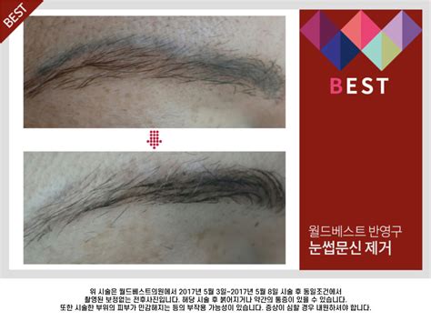 피코레이저 문신제거