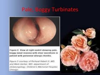 Sinusitis Ppt