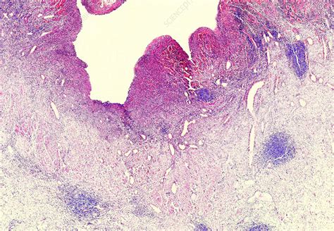 Pseudomembranous Colitis Light Micrograph Stock Image C051 7128