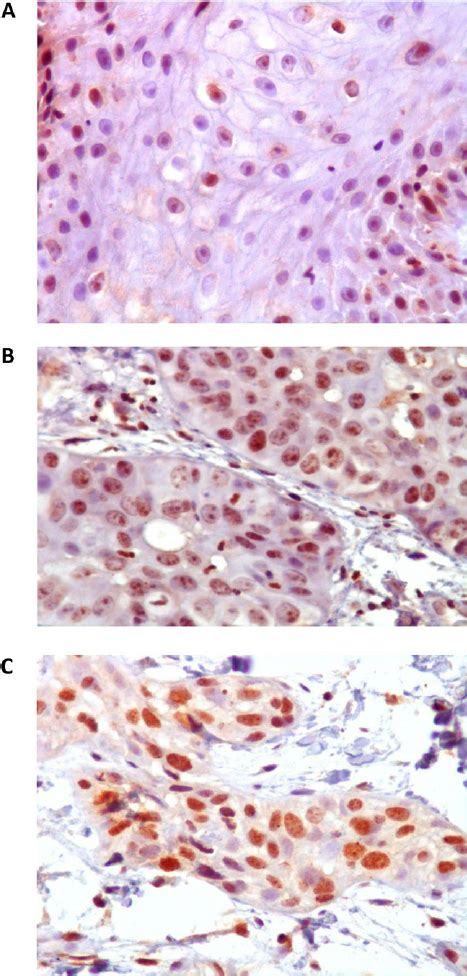 Immunohistochemical Ihc Staining Of Tumor Cells Nuclei For Hpv