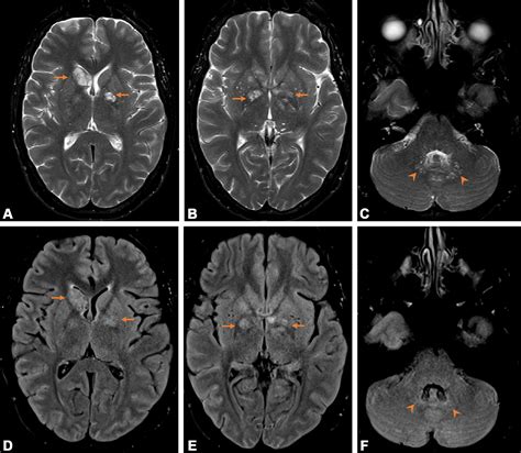 Case 334 Cryptococcal Meningitis Radiology