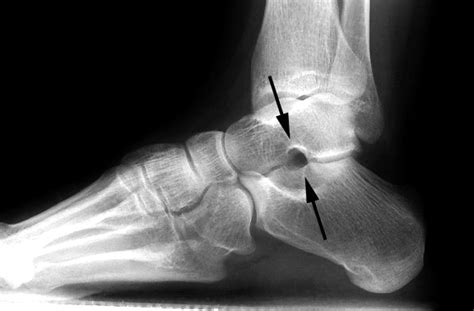 Hyprocure Stent Natural Height Growth