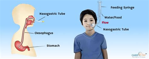 Foley Catheterisation Complete Procedure Nurse For Home
