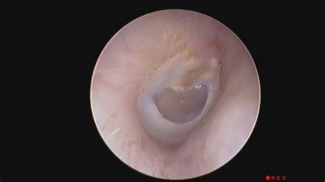 Thin Eardrum Segment From Healed Eardrum Perforation Youtube