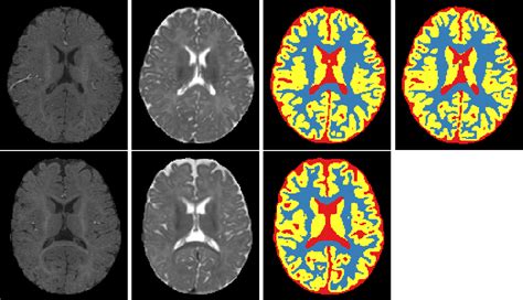 Infant Brain Mri Segmentation Models Code And Papers Catalyzex