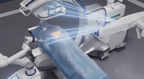 What Are The Advantages Of Using An Orthopedic Surgical Navigation System To Assist In Surgery