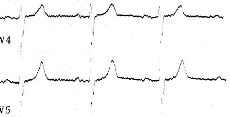 Python Extracting Graph From Printed Ecg Stack Overflow