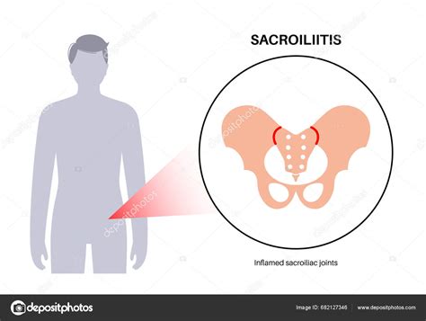 Sacroiliitis Disease Concept Inflamed Sacroiliac Joints Lower Spine