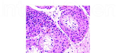 Pseudohermaphroditism