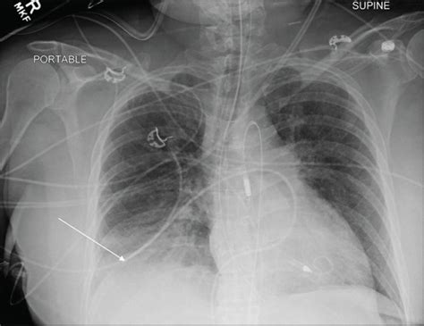 Malpositioned Lines And Tubes On Chest Radiograph A Concise Pictorial