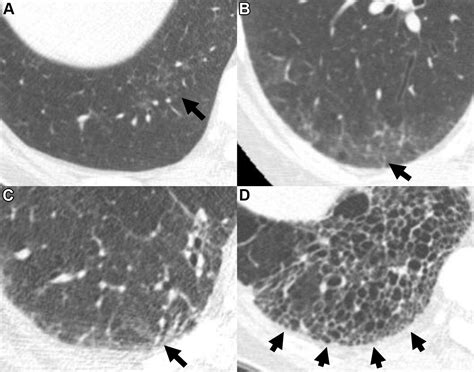 Traction Bronchiectasis Bronchiolectasis On Ct Scans In Relationship To Clinical Outcomes And