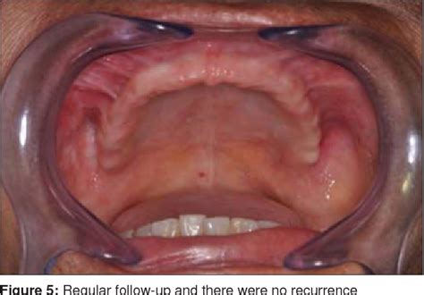 Inflammatory Fibrous Hyperplasia