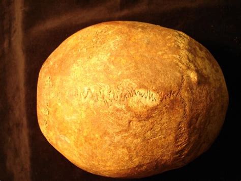 Button Osteoma On The Frontal Bone Superior View Of The Skull Spital