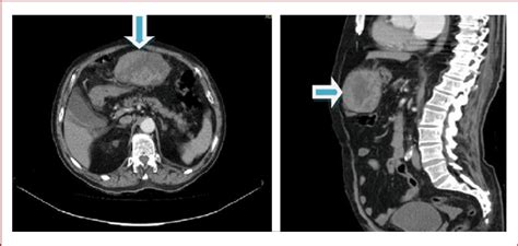 Computed Tomographic Image Of Gastric Gist Download Scientific Diagram