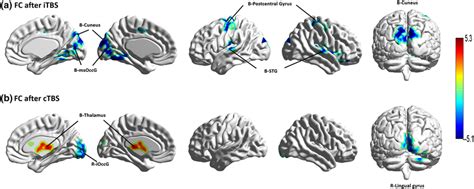 Functional Connectivity After Itbs And Ctbs On Right Precuneus B