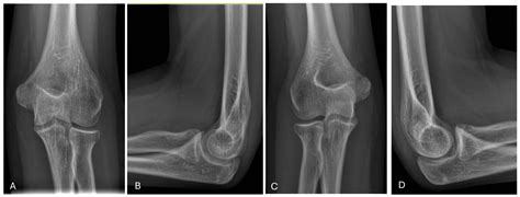 Lateral Condyle Humerus Fracture Ao Lateral Condyle Humerus Fracture Ao