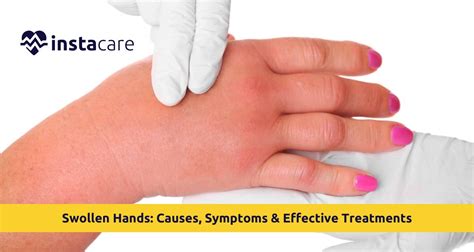 Swollen Hands Causes Symptoms And Effective Treatment Options