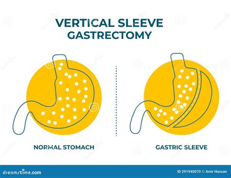 Laparoscopic Sleeve Gastrectomy Vertical Gastrectomy Weight Loss Surgery Vector Illustration