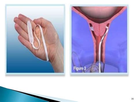 Vaginal Drug Delivery Pptx